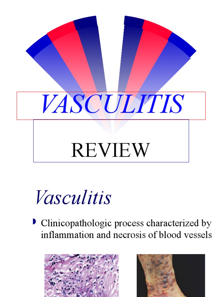 Vasculitis Review | Download Free PDF | Epidemiology | Immunology