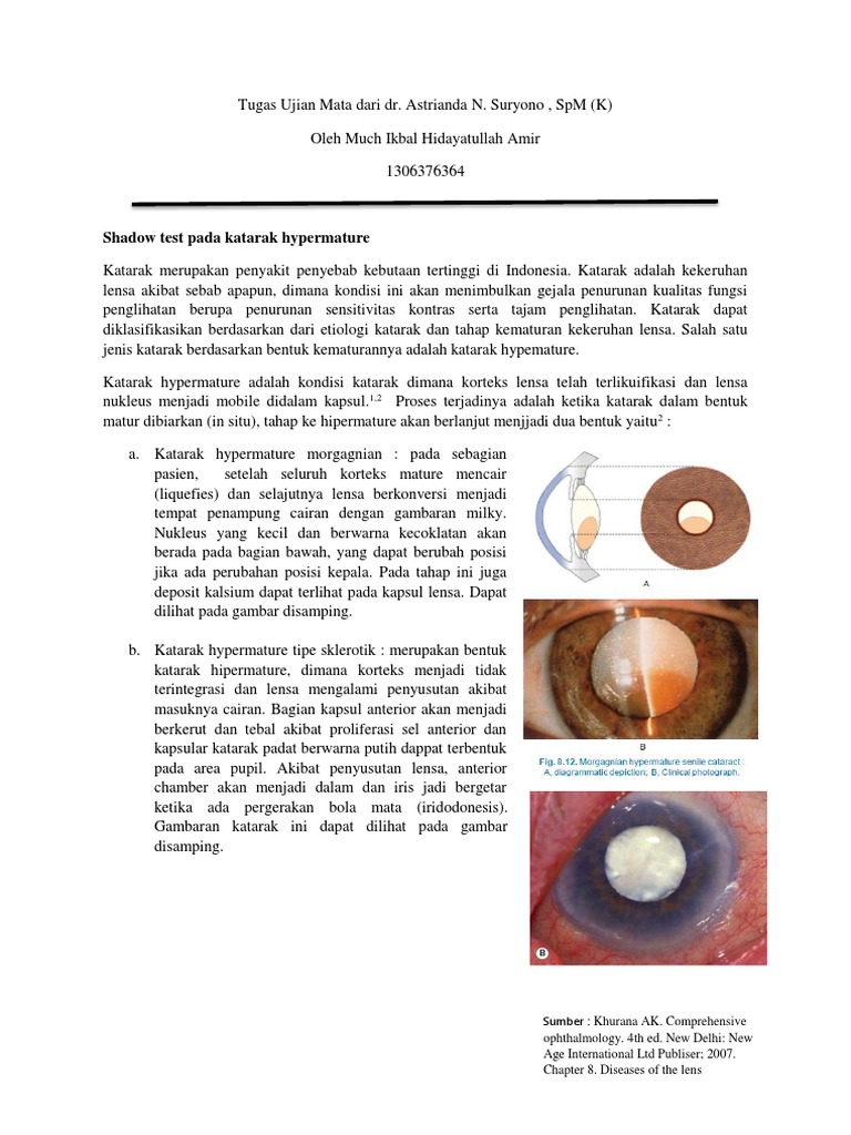 Hipermature Katarak Dan Shadow Test | PDF