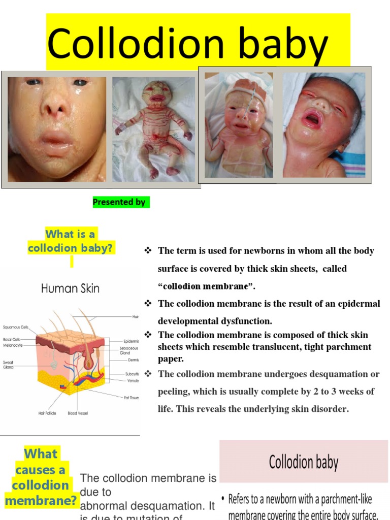 Collodion Baby: Presented by | Download Free PDF | Neonatal Intensive ...
