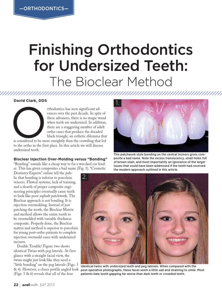 Orthodontics For Undersized Teeth: The Bioclear Method | PDF ...