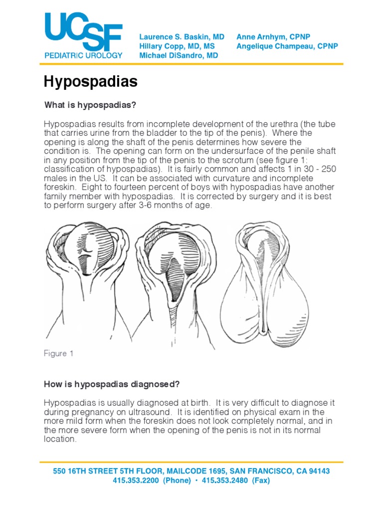 Hypospadias 080615 1 | PDF | Genitourinary System | Human Reproduction