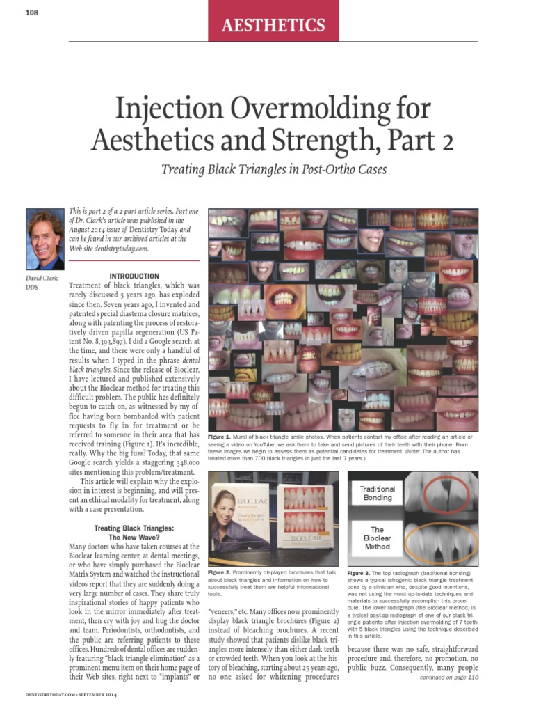 Treating Black Triangles in Post-Orthodontic Cases | PDF | Orthodontics ...
