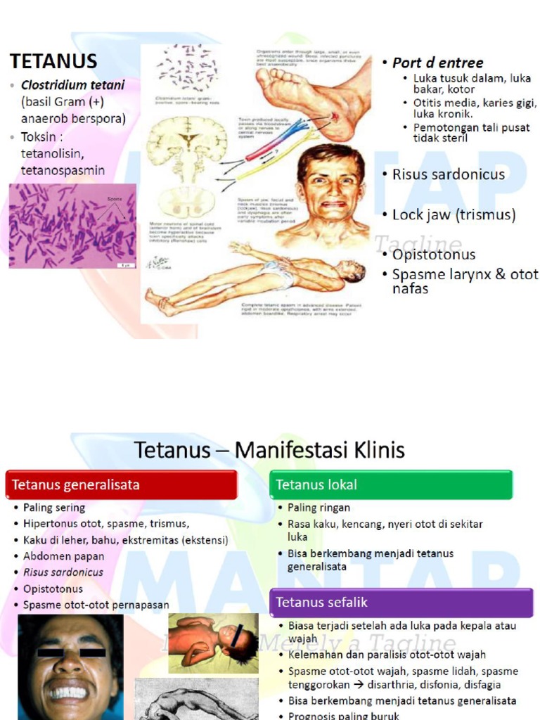 Teori Tetanus | PDF