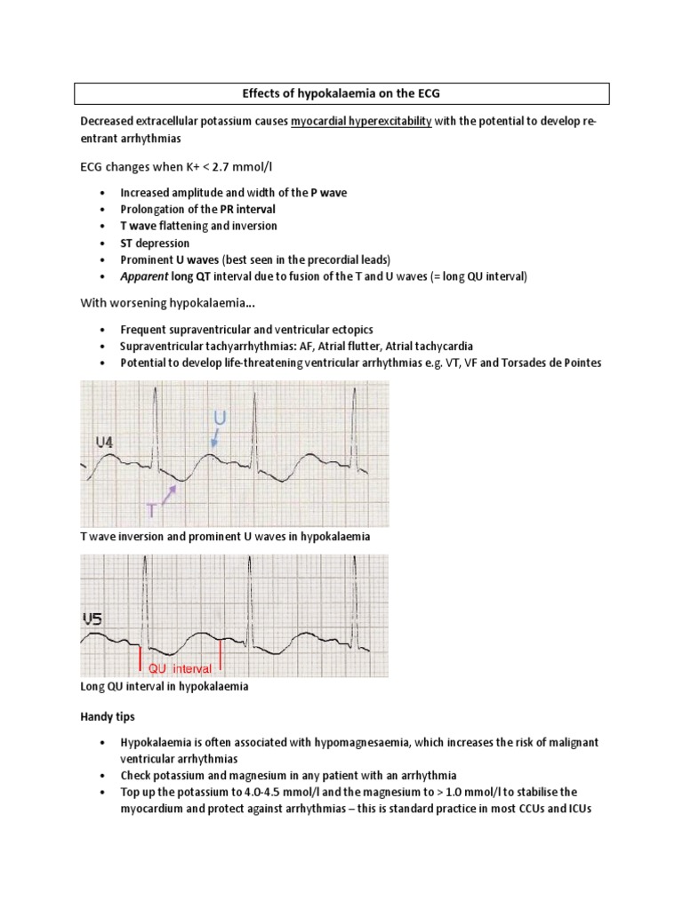 ECG Changes in Hypokalemia | PDF