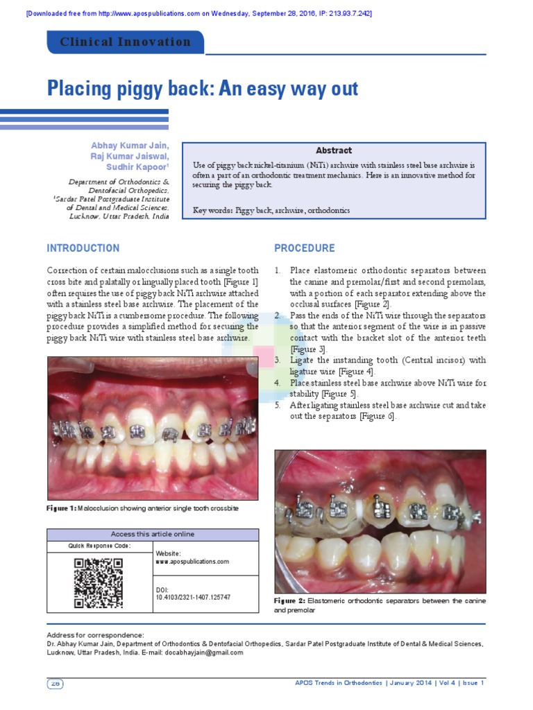 Placing Piggy Back An Easy Way Out | PDF | Orthodontics | Tooth