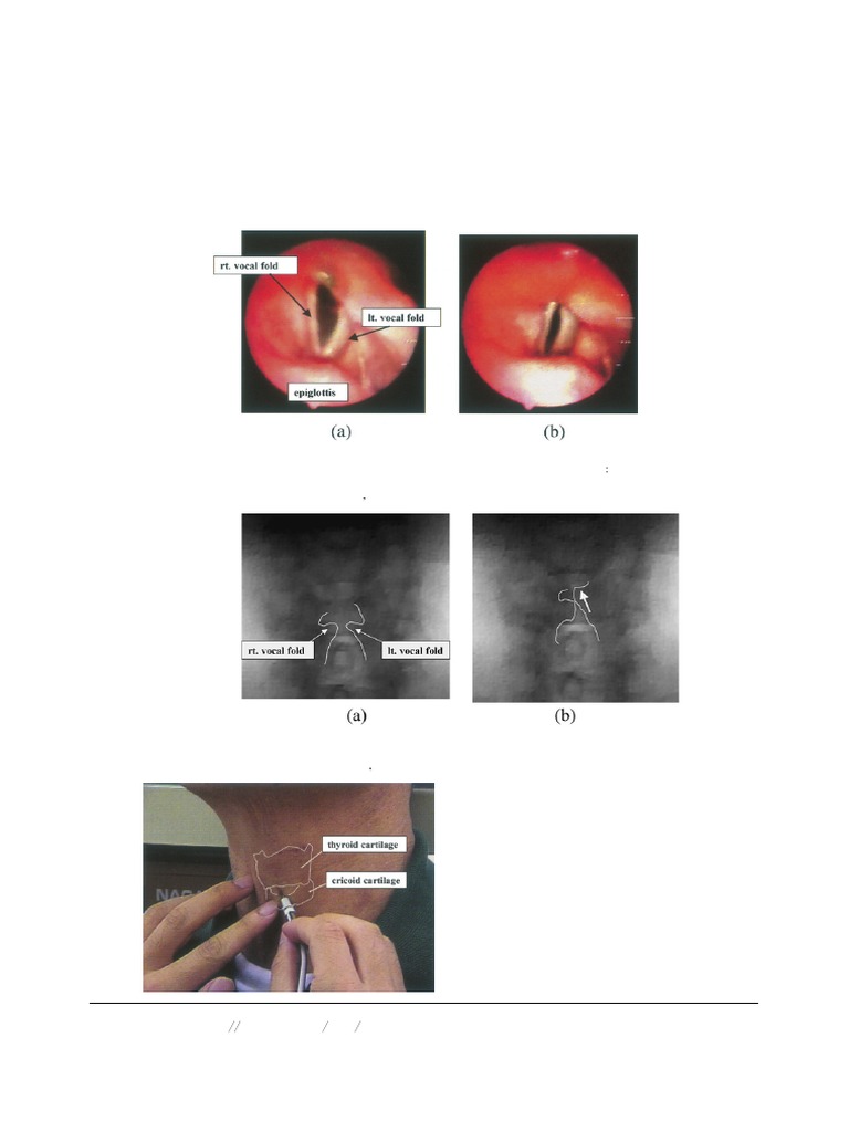 Arytenoid Dislocation: A New Diagnostic and Treatment Approach | PDF ...