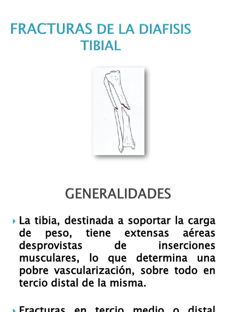 Fracturas de La Diafisis Tibial | PDF | Lesión | Hueso