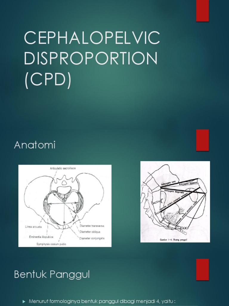 Cephalopelvic Disproportion (CPD) | PDF