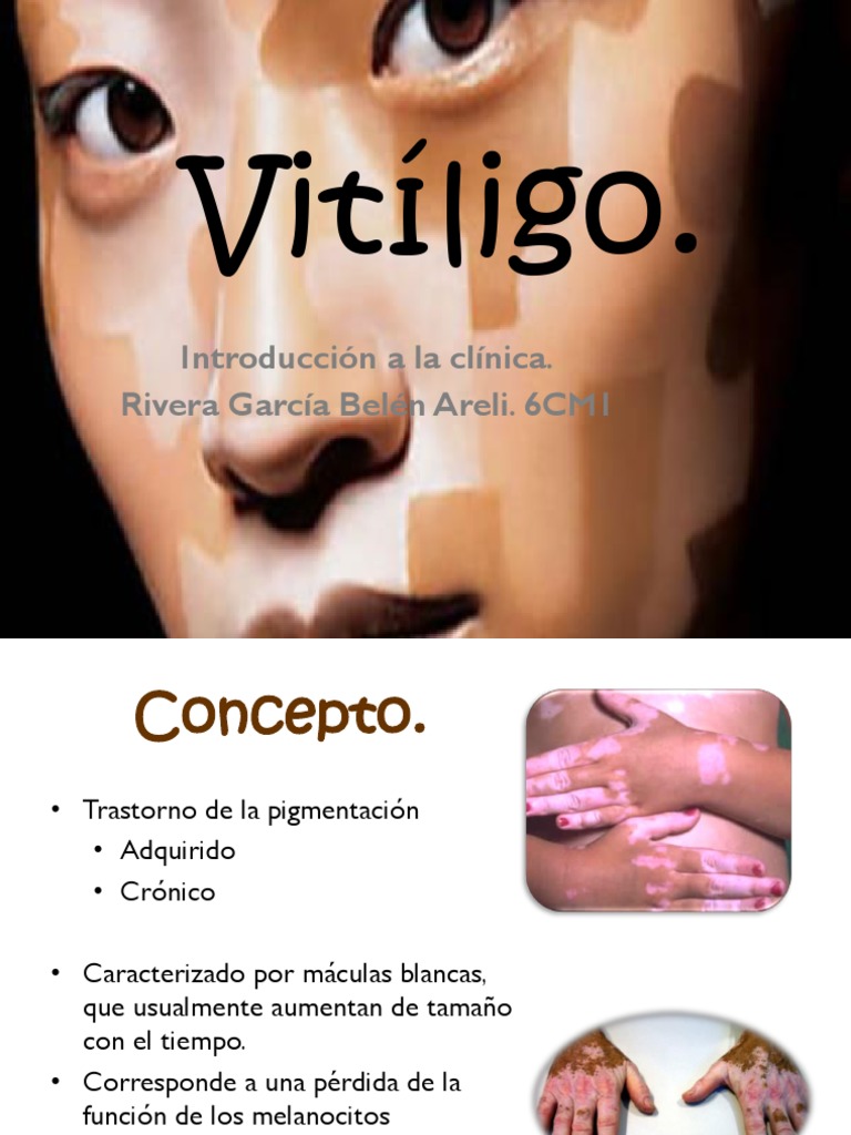 Vitíligo | PDF | Rtt | Epidemiología