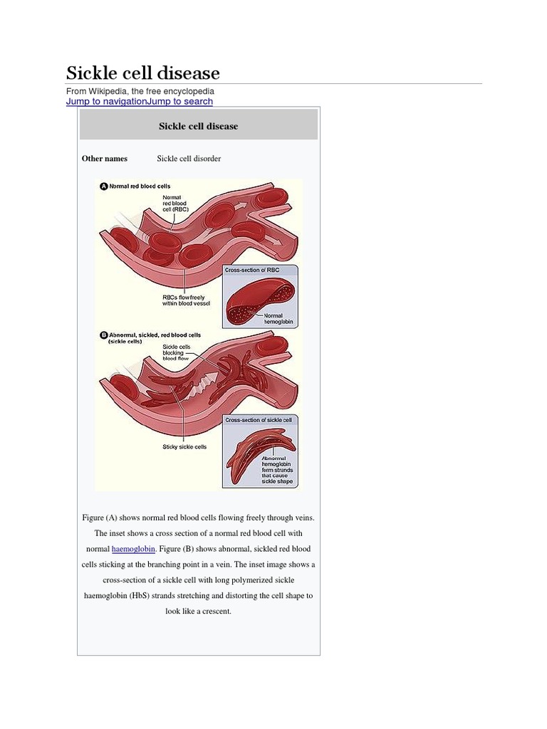 Sickle Cell Disease | PDF | Gene Therapy | Diseases And Disorders