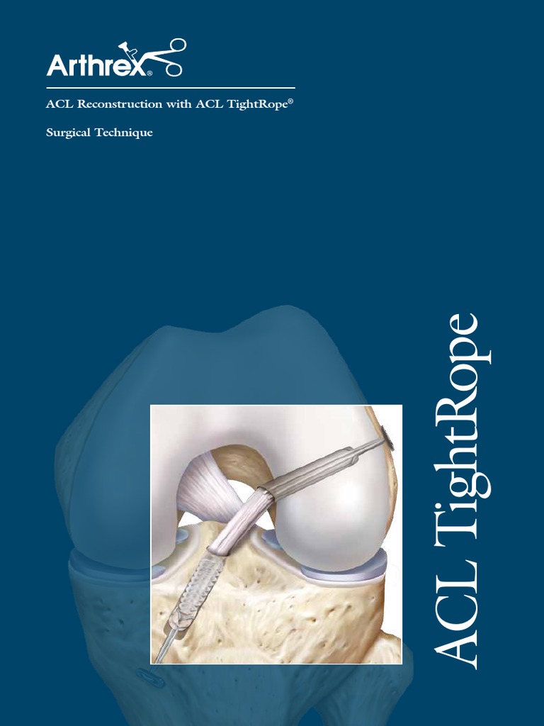 ACL Reconstruction With ACL TightRope | PDF | Musculoskeletal System ...