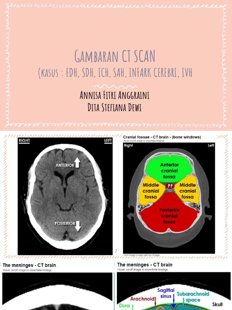 Gambaran CT SCAN: (Kasus: Edh, SDH, Ich, Sah, Infark Cerebri, Ivh | PDF | Neurology | Neuroscience