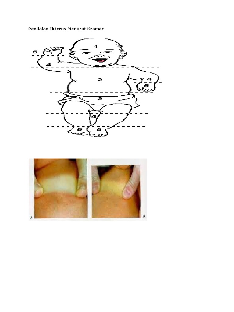 Penilaian Ikterus Menurut Kramer | PDF