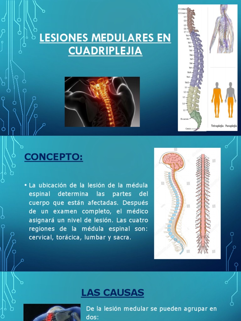 Lesiones Medulares en Cuadriplejia | PDF | Lesión de la médula espinal ...