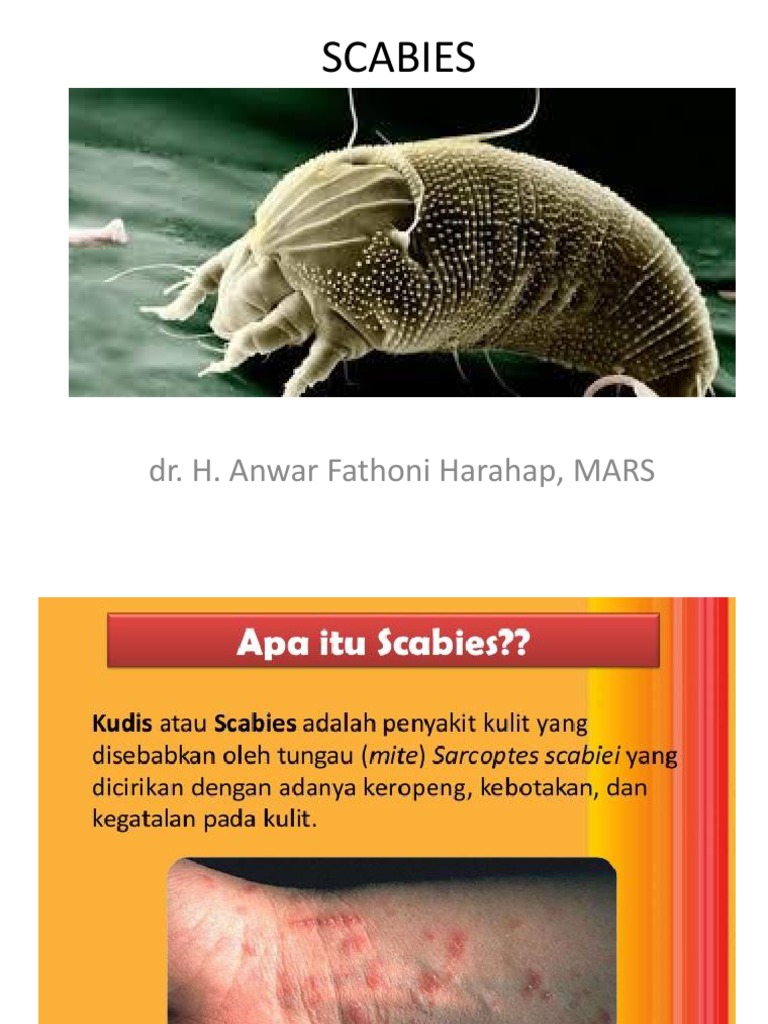 SCABIES | PDF