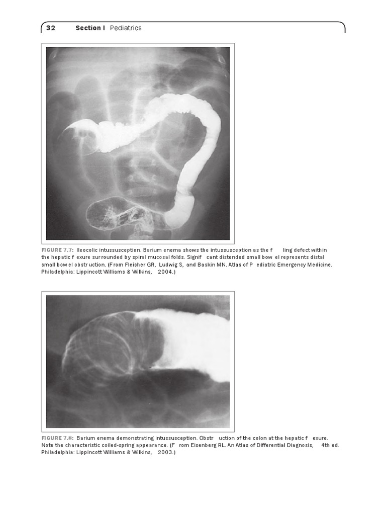 Intuss | PDF | Ct Scan | Clinical Medicine