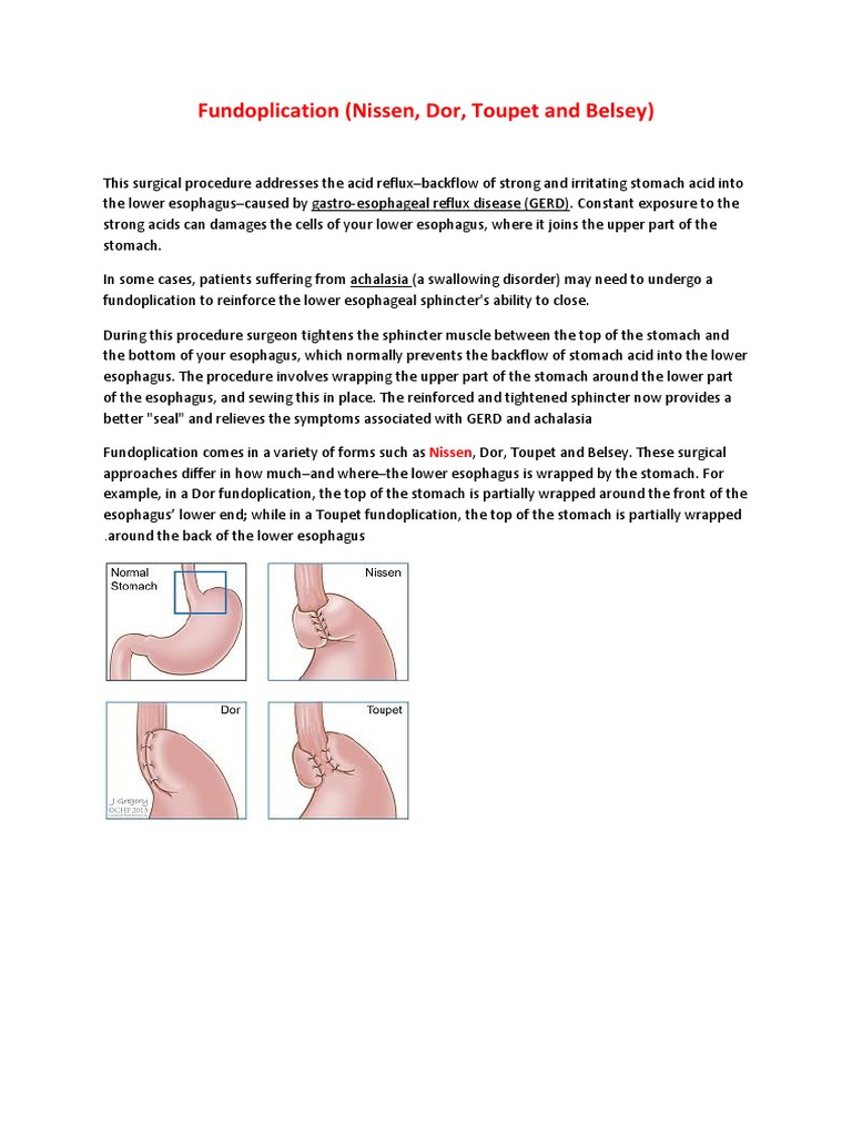 GERD & Achalasia Surgery Guide | PDF | Foreign Language Studies | Wellness