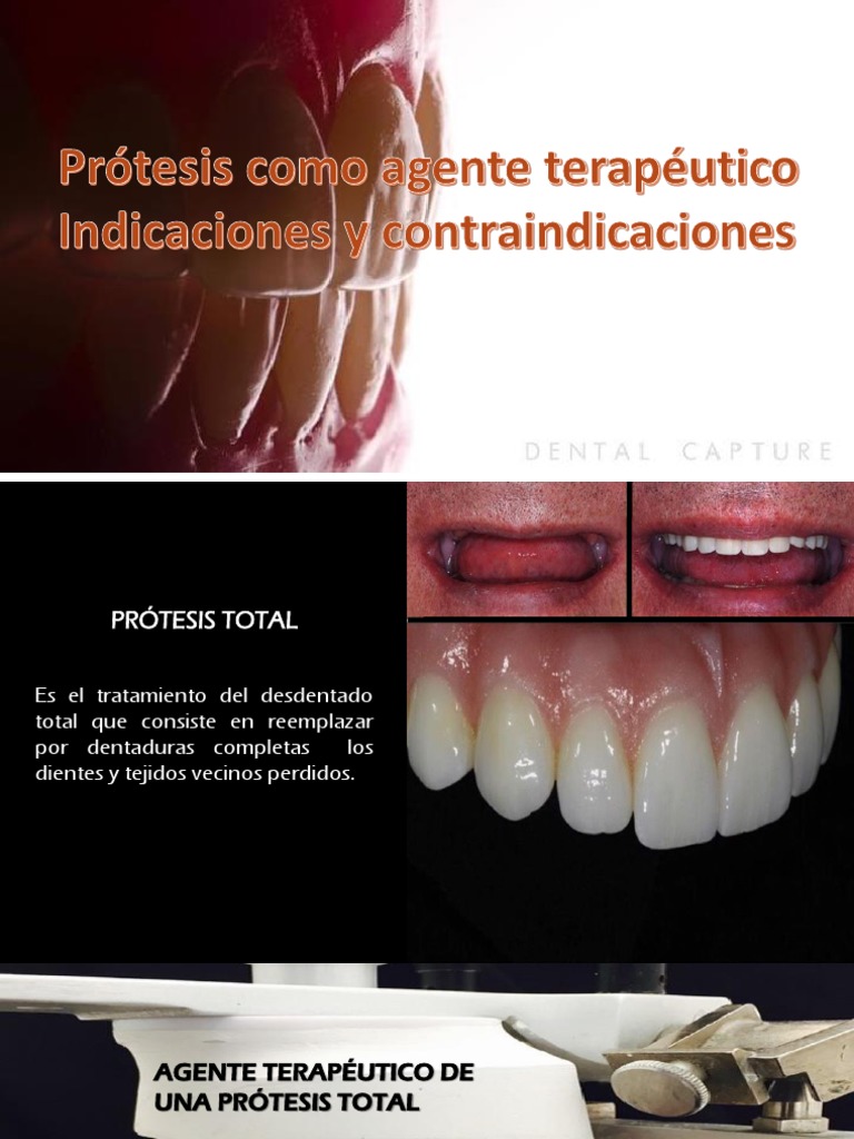 Prótesis Total: Guía Terapéutica | PDF | Dentadura postiza ...
