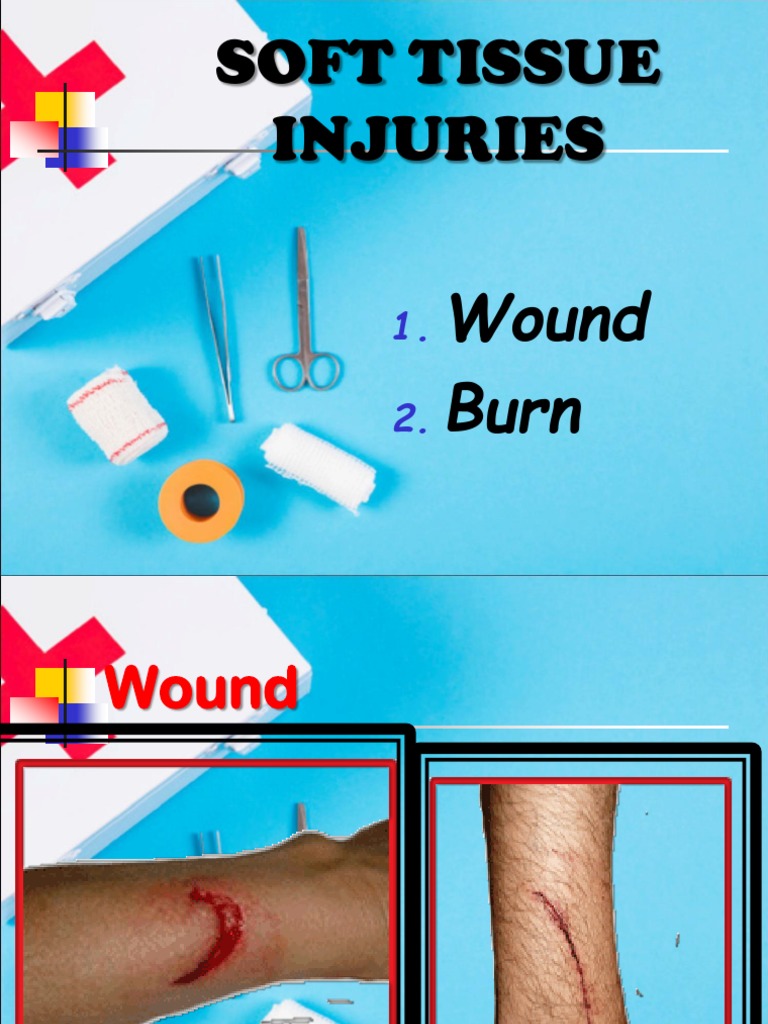 Soft Tissue Injuries: Wound Burn | PDF | Burn | Wound