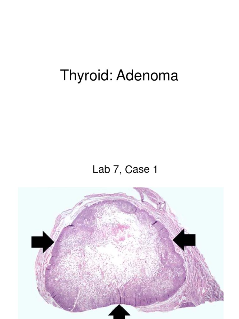 Thyroid: Adenoma: Lab 7, Case 1 | PDF | Neoplasms | Epithelium