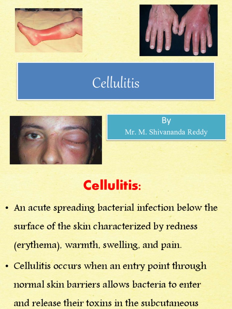 Cellulitis | PDF
