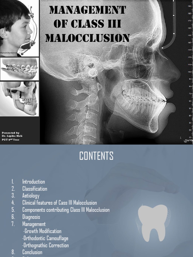 Management of Class III Malocclusion | PDF | Animal Anatomy | Dentistry ...