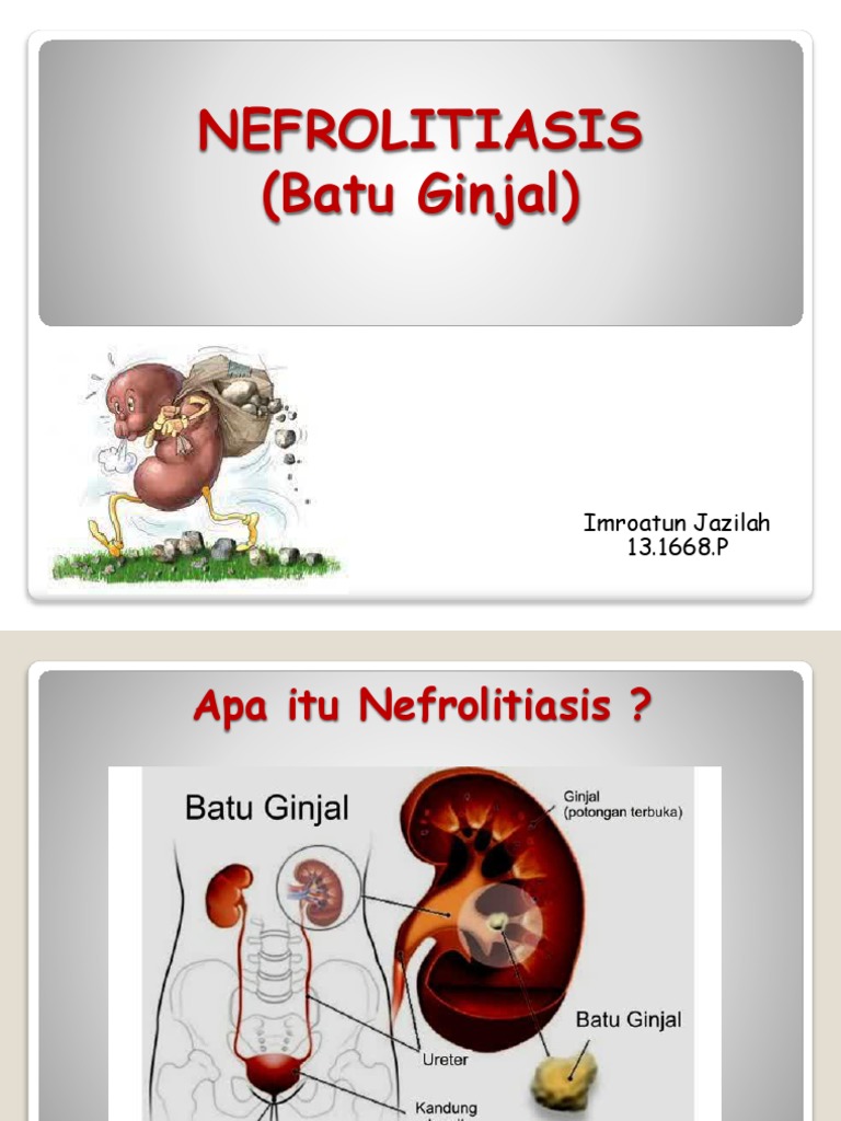 Lembar Balik Nefrolitiasis | PDF