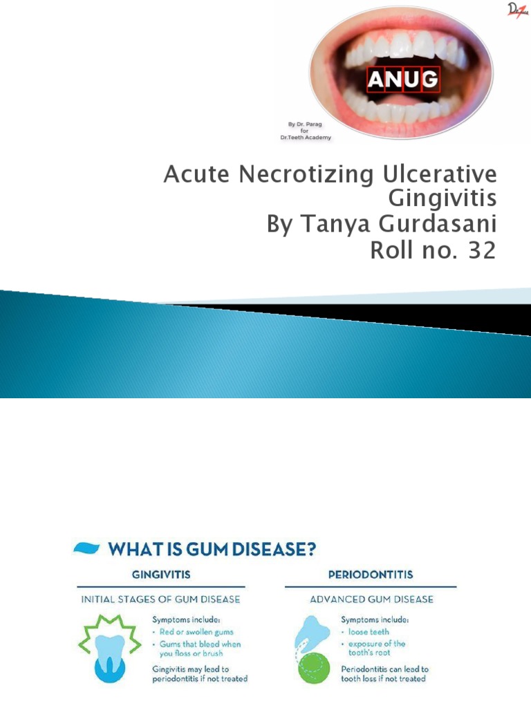 Acute Necrotizing Ulcerative Gingivitis | PDF | Dentistry Branches ...