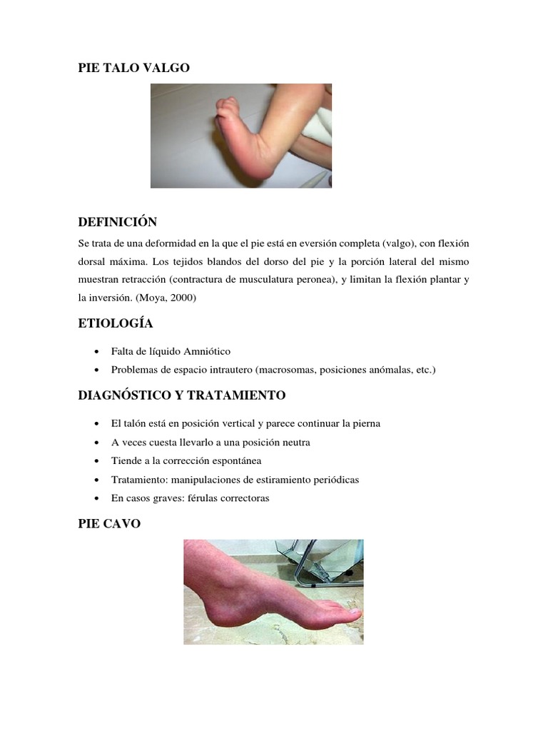 Pie Talo Valgo | Pie | Enfermedades y trastornos
