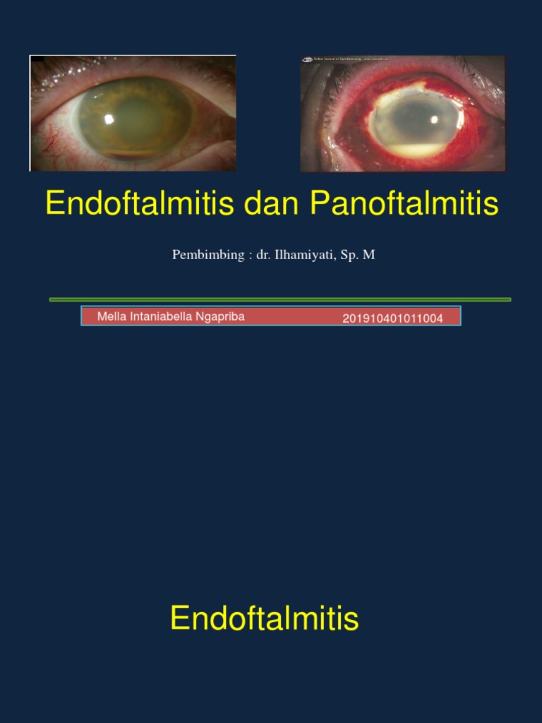 Perbandingan Endoftalmitis dan Panoftalmitis | PDF | Pengembangan Diri ...
