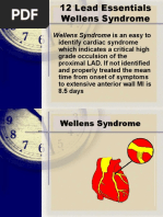 Understanding Wellens Syndrome ECG Patterns | PDF | Electrocardiography ...