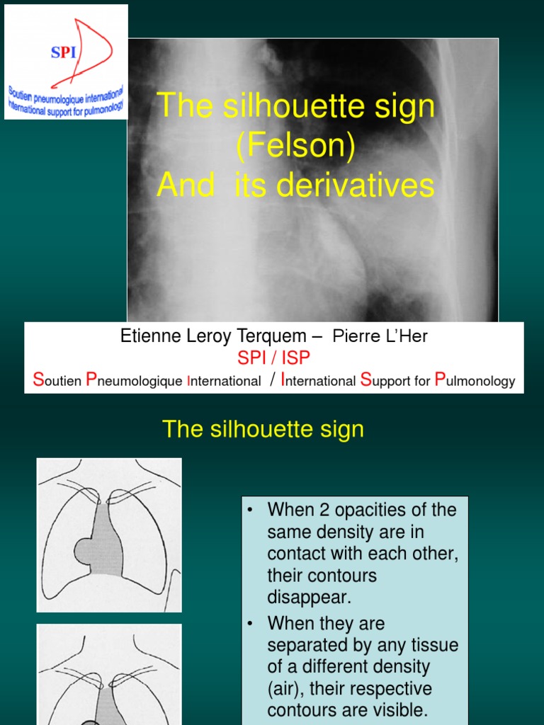 The Silhouette Sign (Felson) and Its Derivatives: Etienne Leroy Terquem ...
