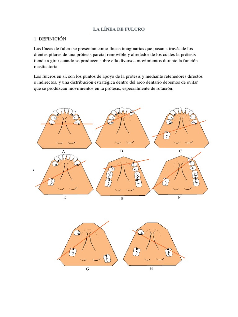 Líneas de fulcro en prótesis parciales removibles | PDF
