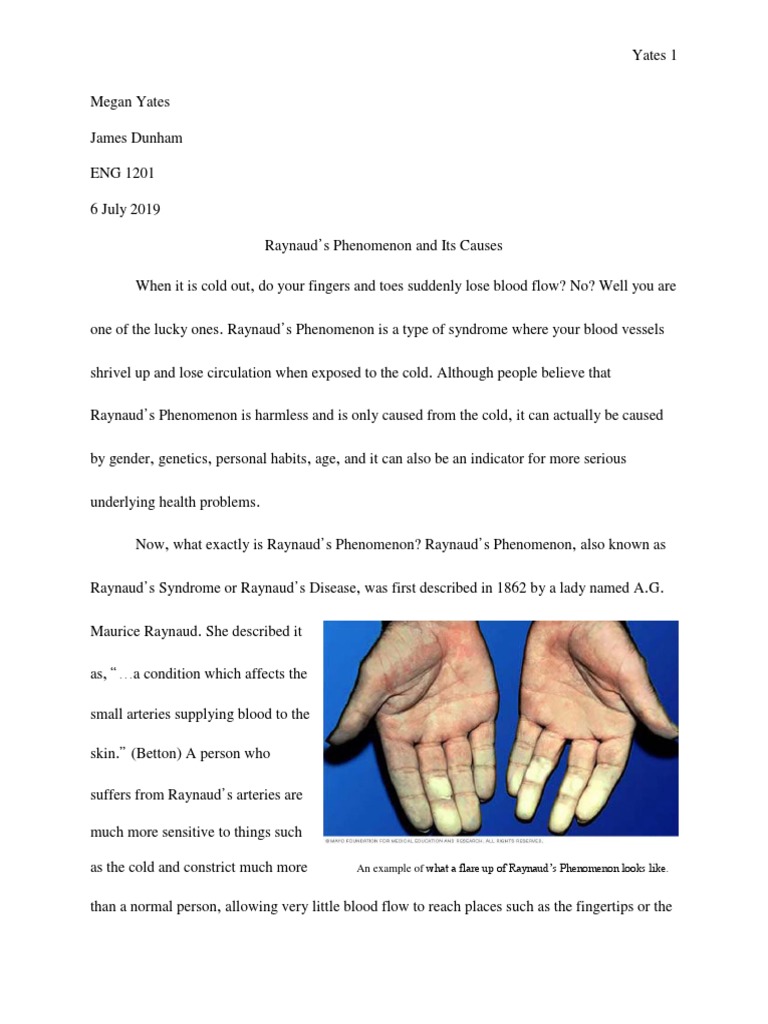 An Example of What A Flare Up of Raynaud's Phenomenon Looks Like | PDF ...