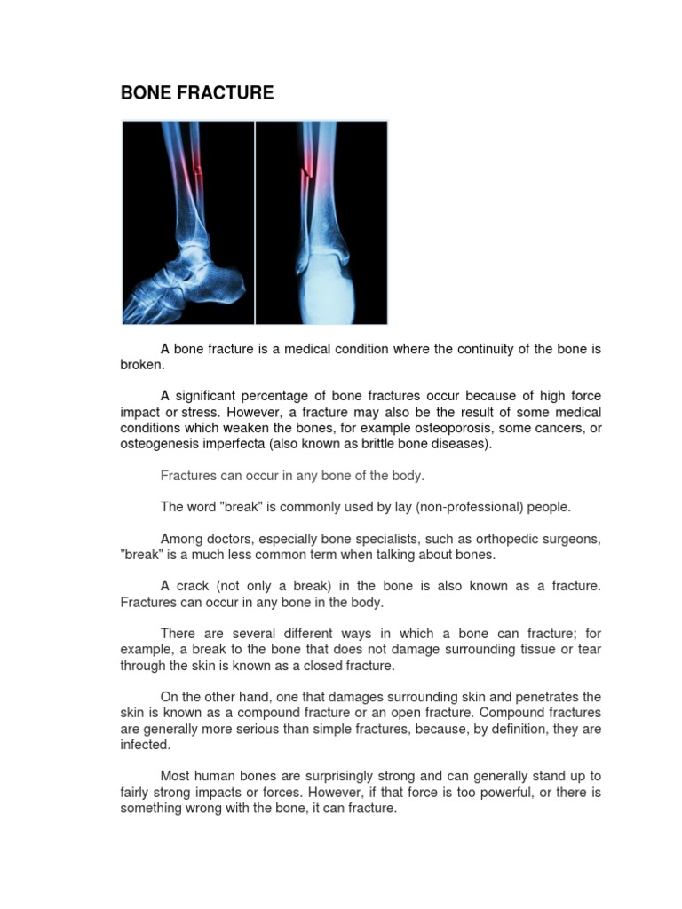Bone Fracture | PDF | Bone | Clinical Medicine