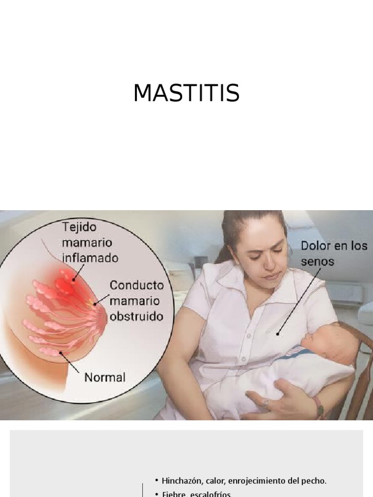 Mastitis | PDF | Pecho | Amamantamiento