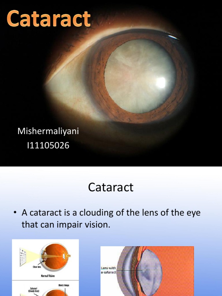 Immature Senile Cataract Iris Shadow