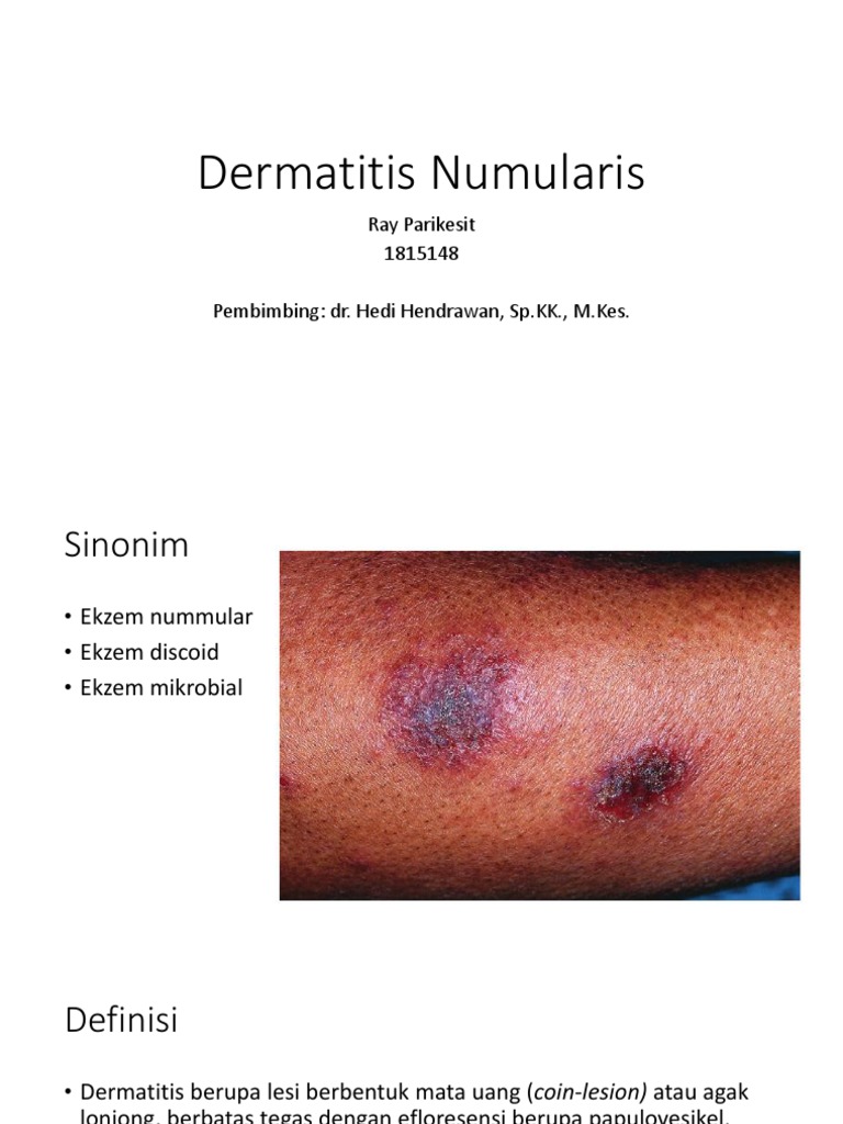 Dermatitis Numularis | PDF | Sains & Matematika