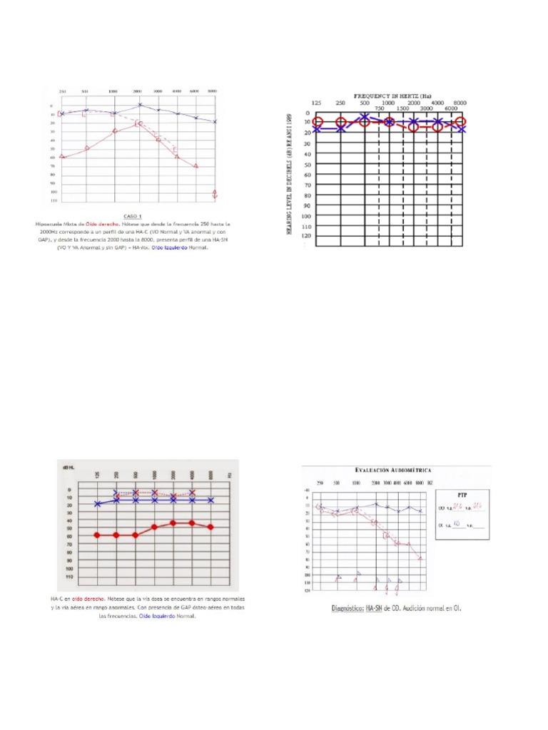 Ejemplos de Audiograma | PDF