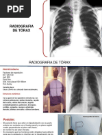 Proyeccion AP Lordotica | PDF | Pulmón | Hombro