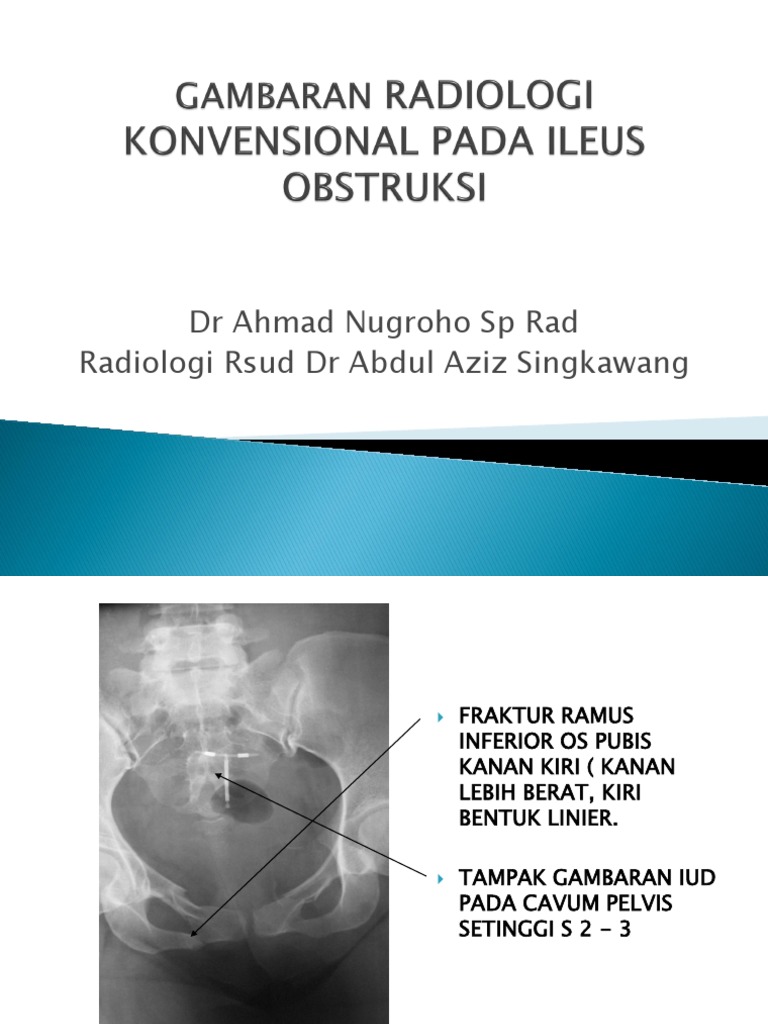Power Point Ileus | PDF
