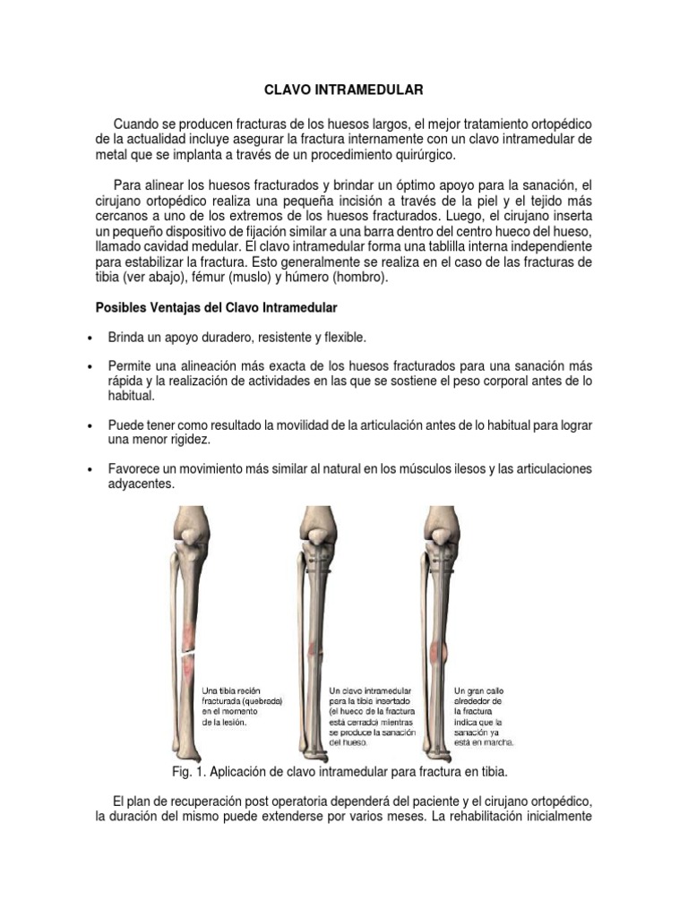 Informe Clavo Intramedular | PDF | Cirugía | Hueso