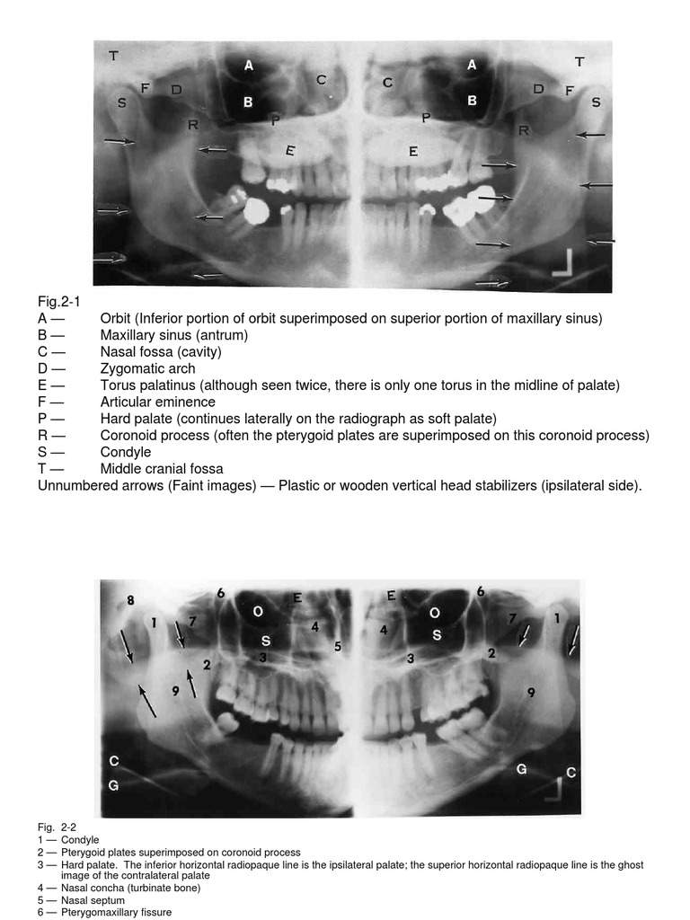 Panoramic Radiograph Anatomy Overview | PDF | Anatomical Terms Of ...