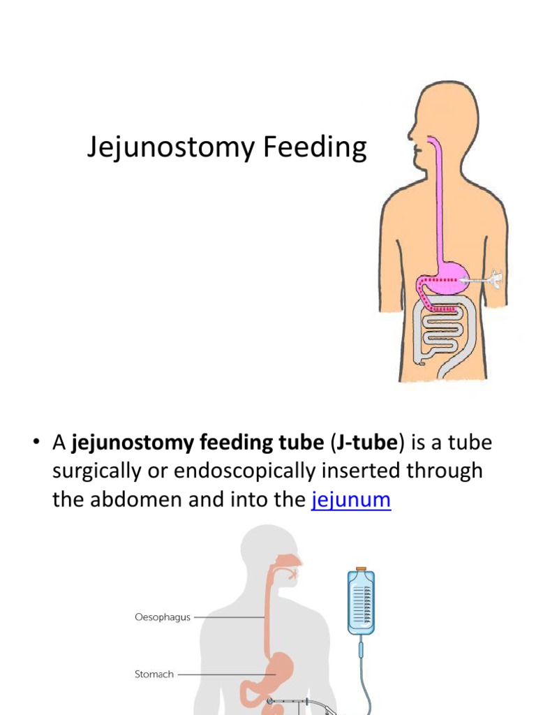 Jejunostomy Feeding | PDF | Wellness
