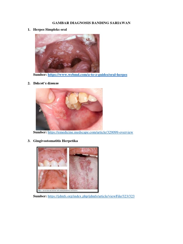 Gambar Diagnosis Banding Sariawan | PDF