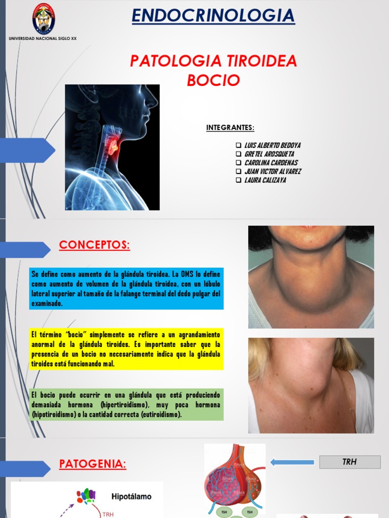 bocio endemico | Tiroides | Hormona estimulante de la tiroides