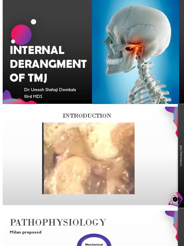 Internal Derangement of TMJ | PDF | Analgesic | Medical Specialties