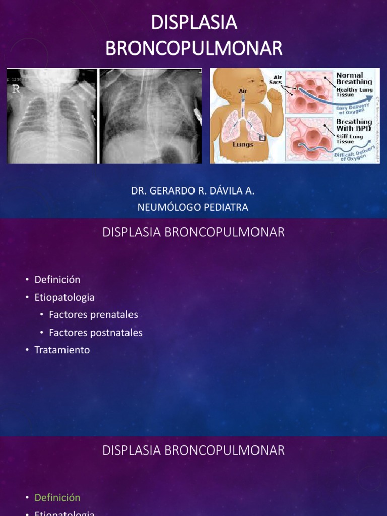 DISPLASIA BRONCOPULMONAR 2019 Tratamiento | PDF | Sistema respiratorio ...