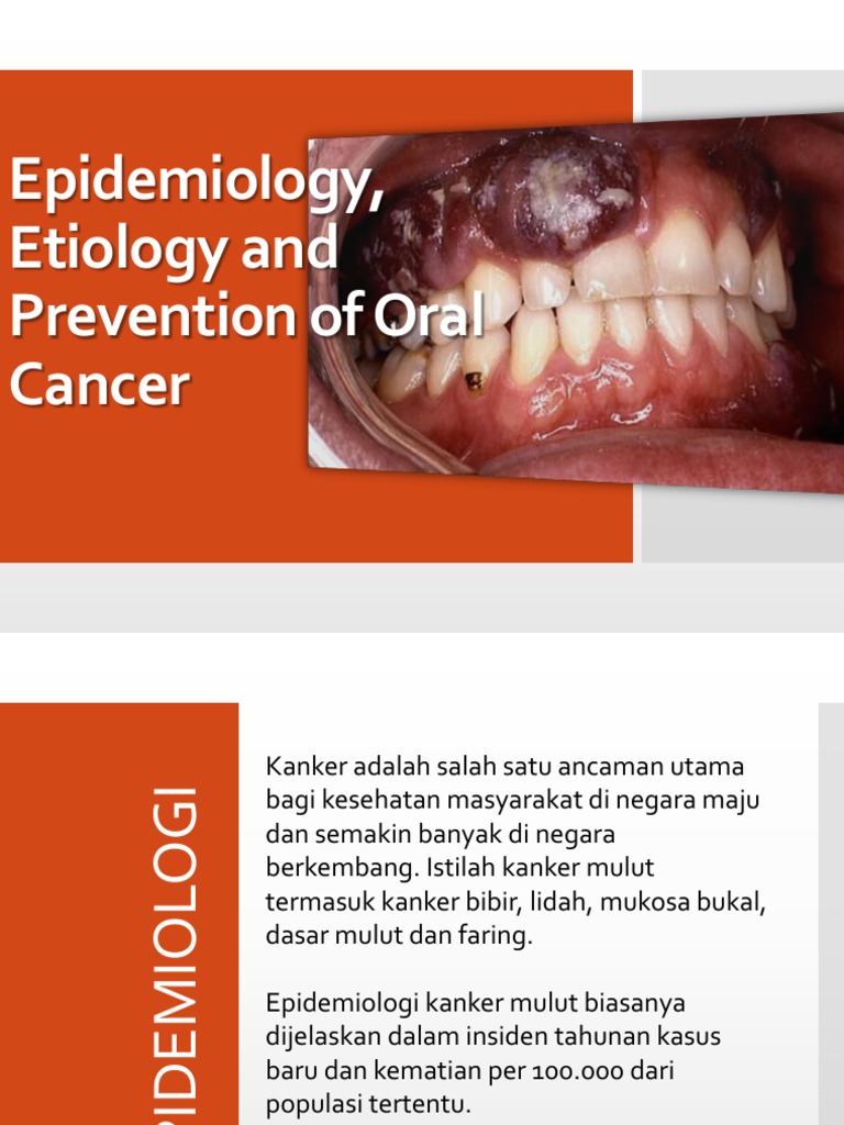 Oral Cancer | PDF