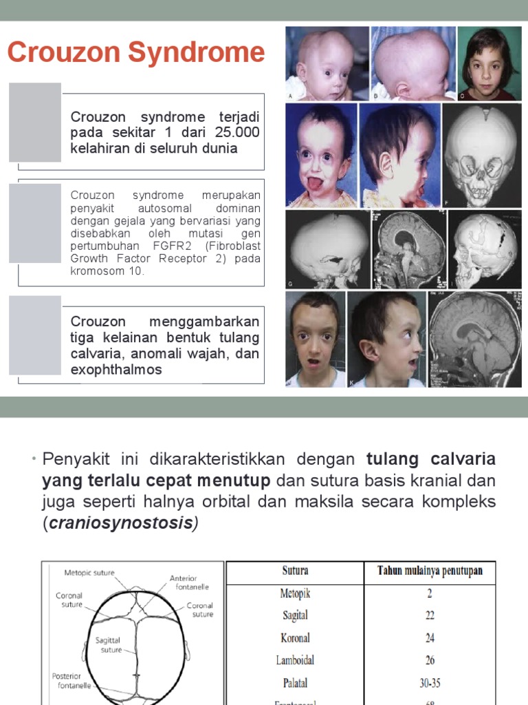 Crouzon Syndrome | PDF